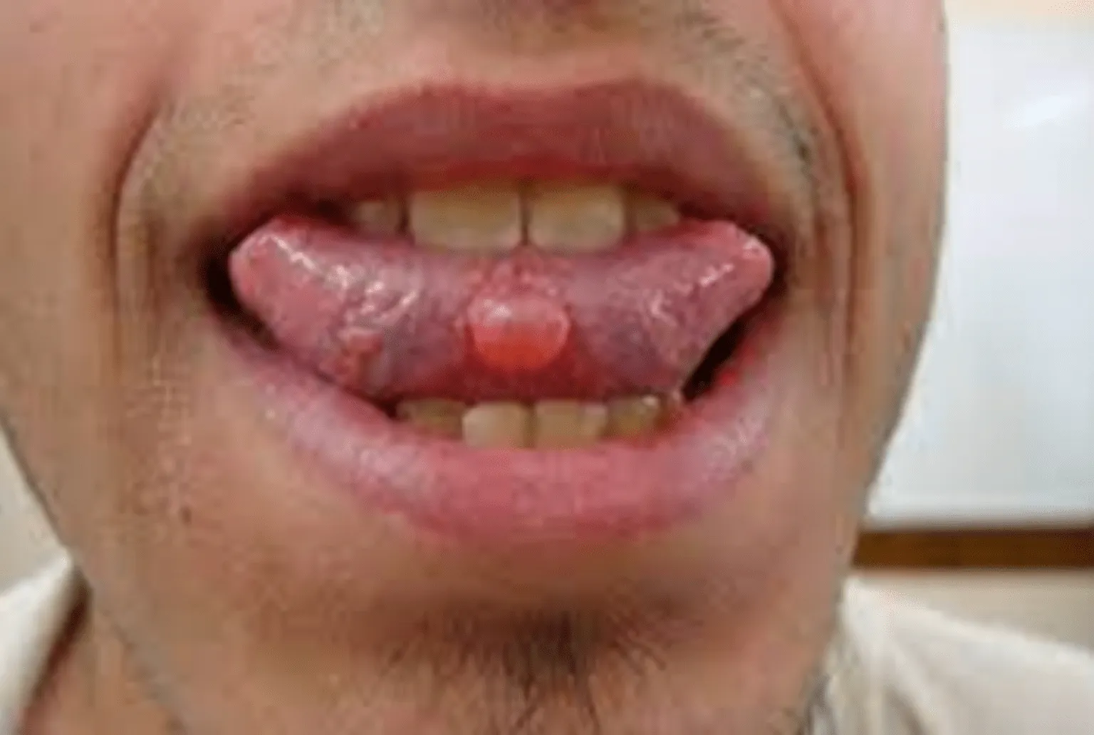 Understanding Oral Mucocele: Causes, Symptoms, and Treatment ...