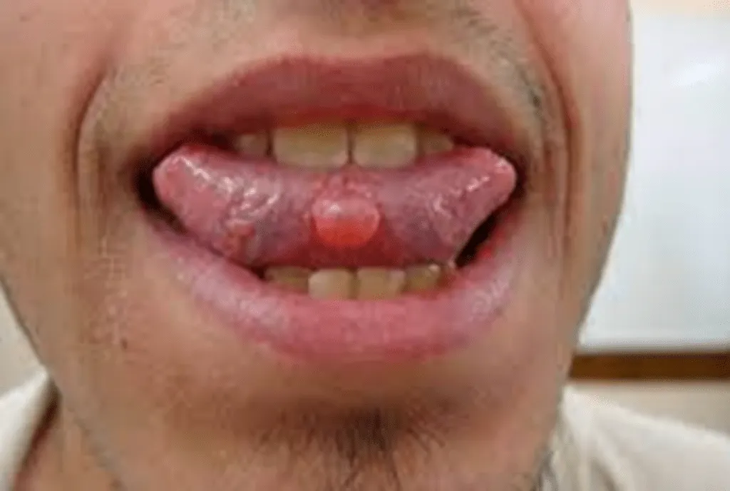 Understanding Oral Mucocele: Causes, Symptoms, and Treatment ...